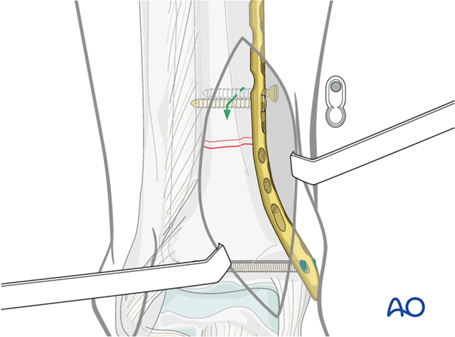 ORIF - Compression plate for Extraarticular, simple fracture