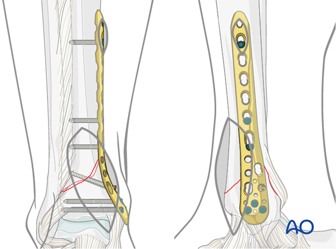 ORIF - Compression plate for Extraarticular, simple fracture