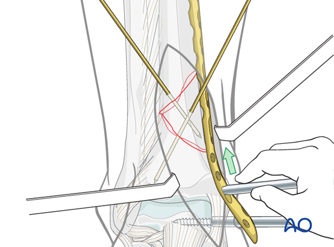 ORIF - Lag screw and protection plate for Extraarticular, wedge fracture