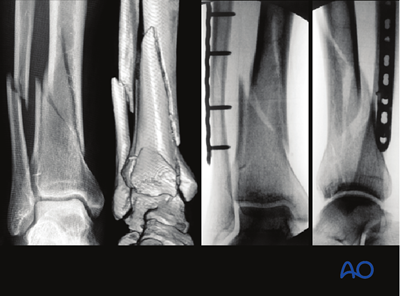 ORIF - Plate and screws through anteromedial approach for Complete ...