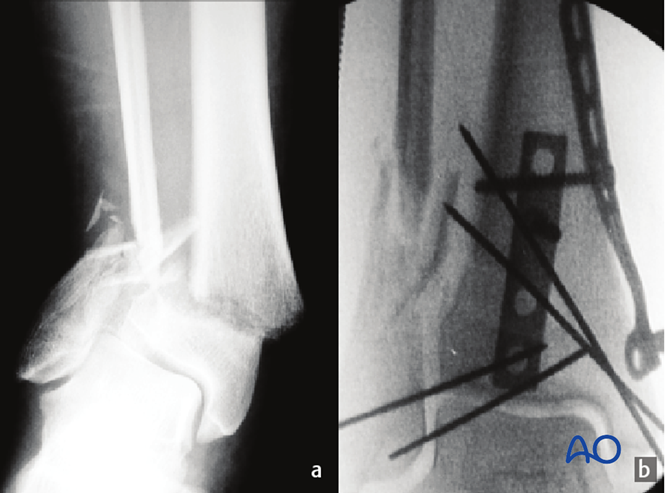ORIF - Plate and screws through anteromedial approach for Complete ...