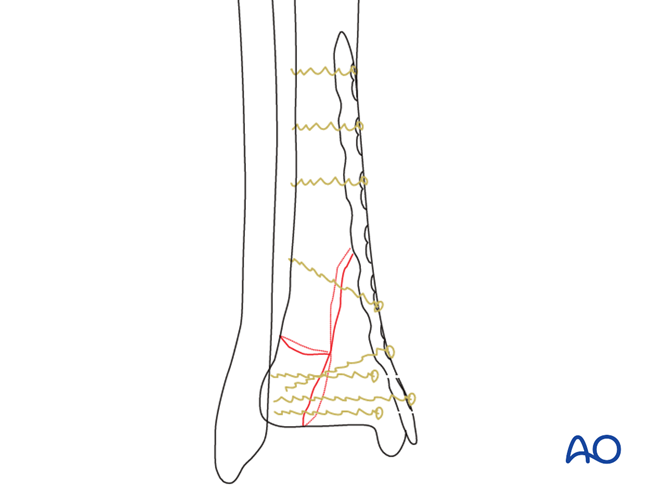 ORIF - Plate and screws for Complete simple articular, simple ...