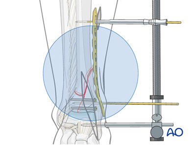 ORIF - Plate and screws for Complete simple articular, simple ...