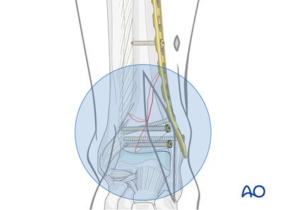 ORIF - Plate and screws for Complete simple articular, simple ...