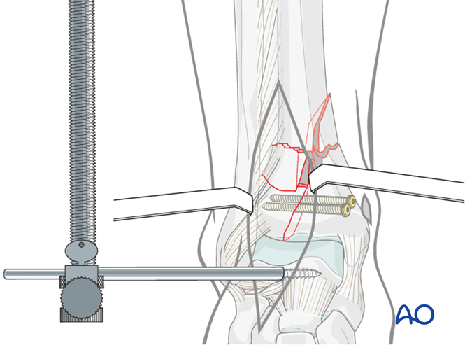 ORIF - Plate and screws for Complete simple articular, multifragmentary ...
