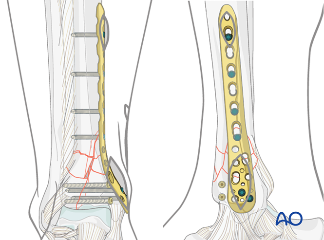 ORIF - Plate and screws for Complete simple articular, multifragmentary ...