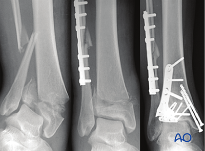 ORIF - Plate and screws through anterolateral approach for Complete ...