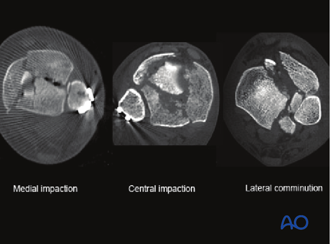 Anteromedial or anterolateral approach to the distal tibia?