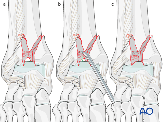 Anteromedial or anterolateral approach to the distal tibia?
