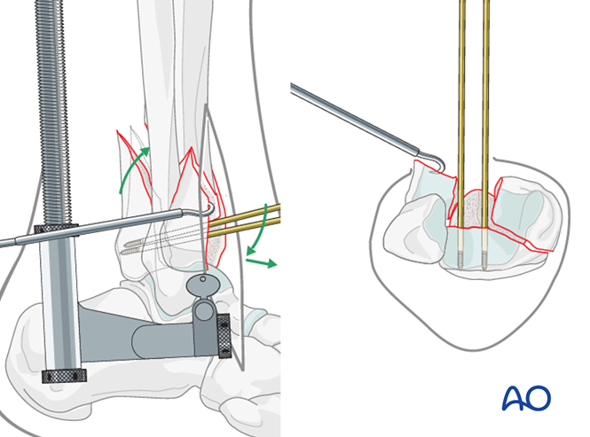 ORIF - Plate and screws through anterolateral approach for Complete ...