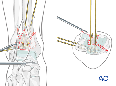 ORIF - Plate and screws through anterolateral approach for Complete ...