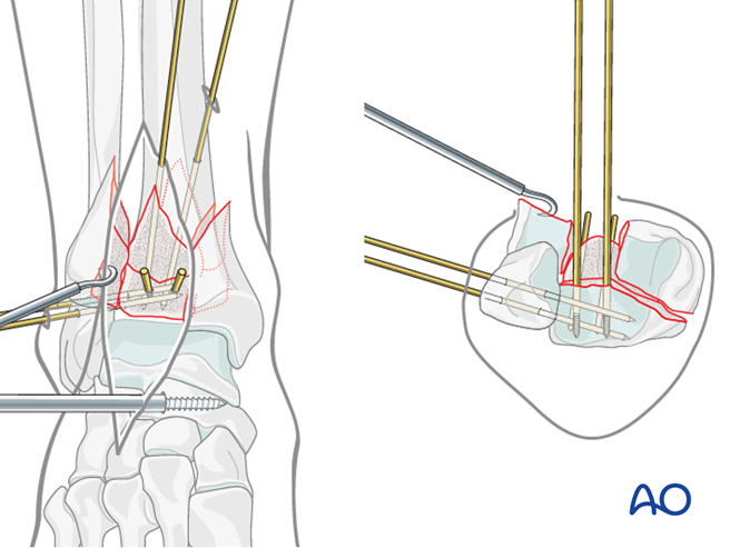 ORIF - Plate and screws through anterolateral approach for Complete ...
