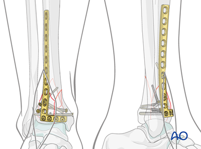 ORIF - Plate and screws through anterolateral approach for Complete ...