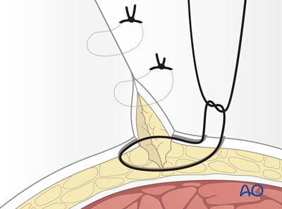 ORIF - Plate and screws through anterolateral approach for Complete ...