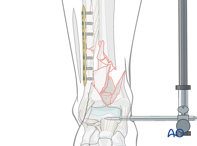 ORIF - Plate and screws through anteromedial approach for Complete ...