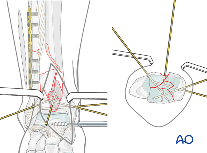 ORIF - Plate and screws through anteromedial approach for Complete ...