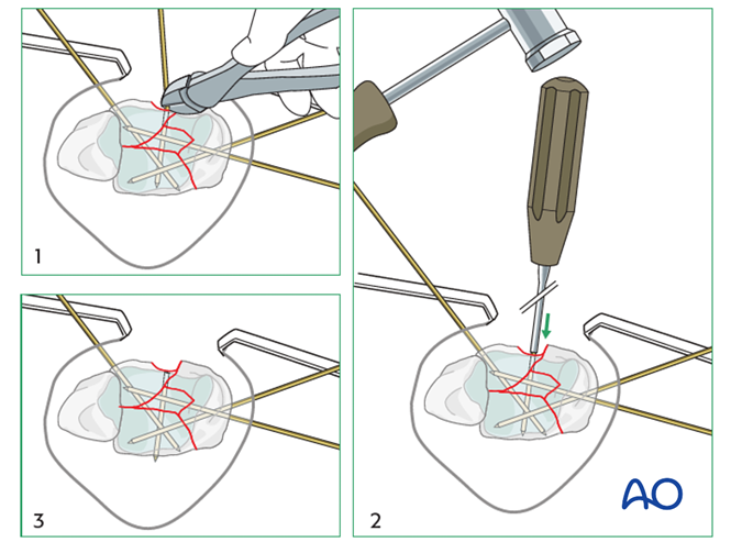 ORIF - Plate and screws through anteromedial approach for Complete ...