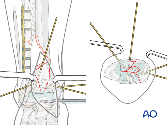 ORIF - Plate and screws through anteromedial approach for Complete ...