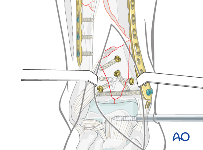 ORIF - Plate and screws through anteromedial approach for Complete ...