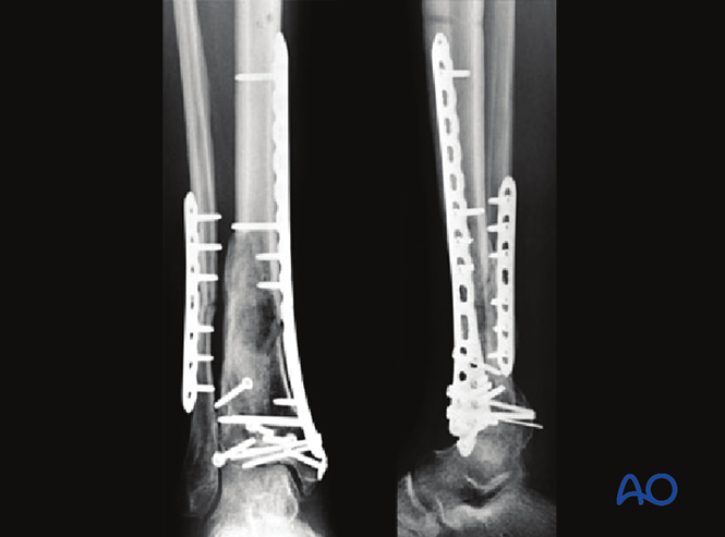 ORIF - Plate and screws through anteromedial approach for Complete ...