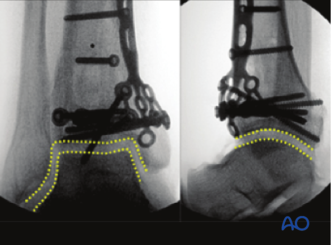 Assessment of reduction of type A distal tibial fractures
