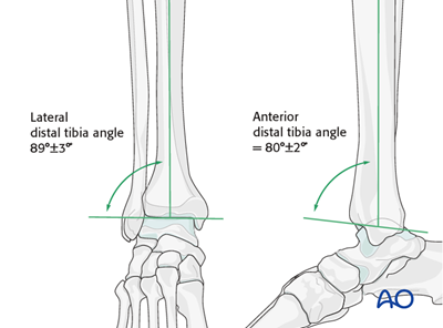 Assessment of reduction of type A distal tibial fractures