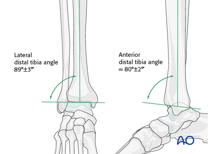 Assessment of reduction of type A distal tibial fractures