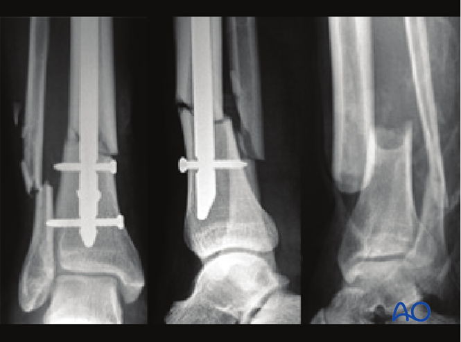 Assessment of reduction of type A distal tibial fractures