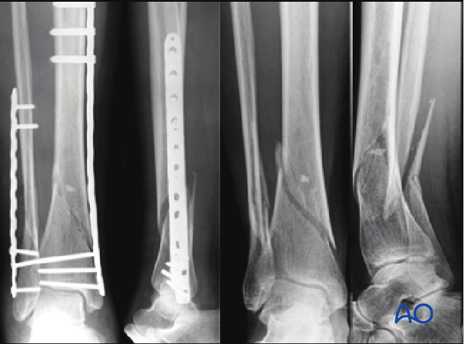 Assessment of reduction of type A distal tibial fractures