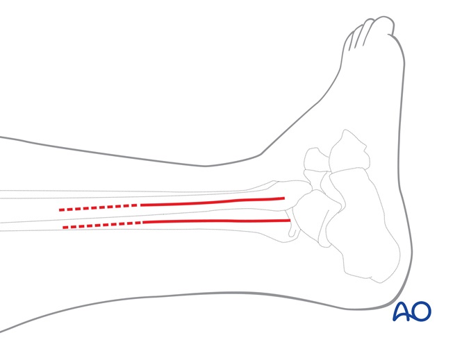 Lateral approach to the malleoli