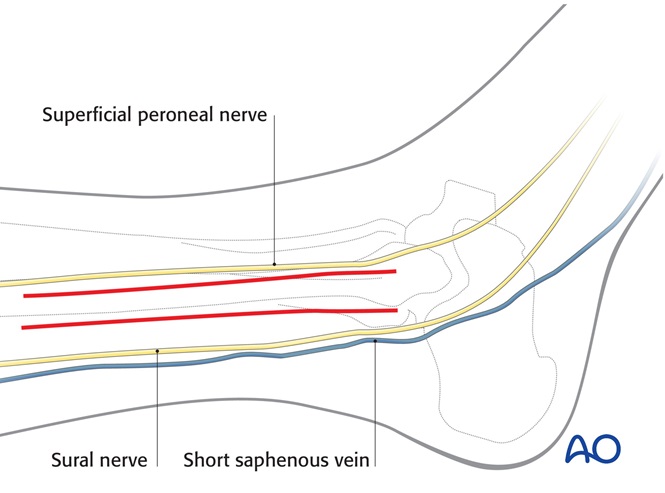 Lateral approach to the malleoli for high fibular fractures