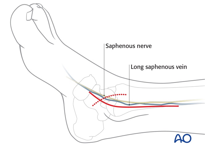 Medial approach (anterior) to the malleoli