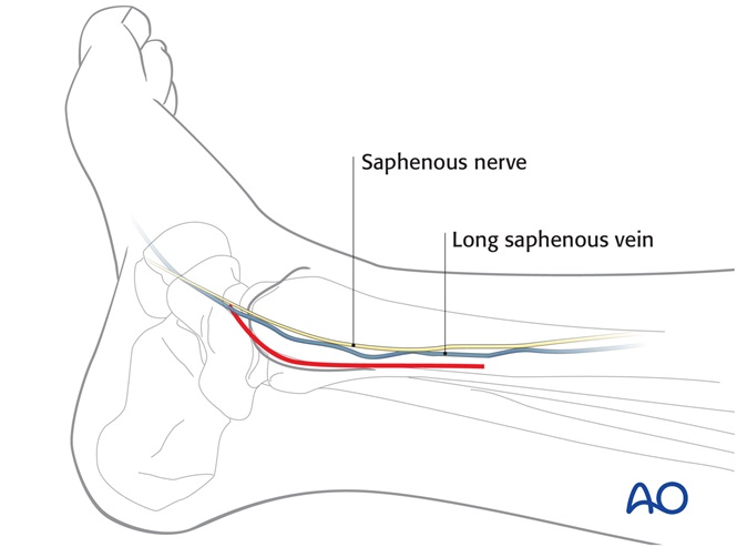 Posteromedial approach to the malleoli