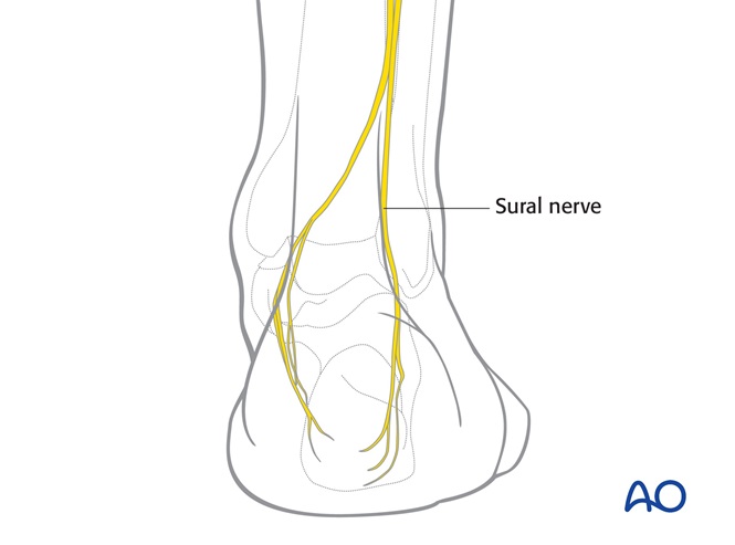 Posterolateral approach to the Volkmann fragment in the malleoli