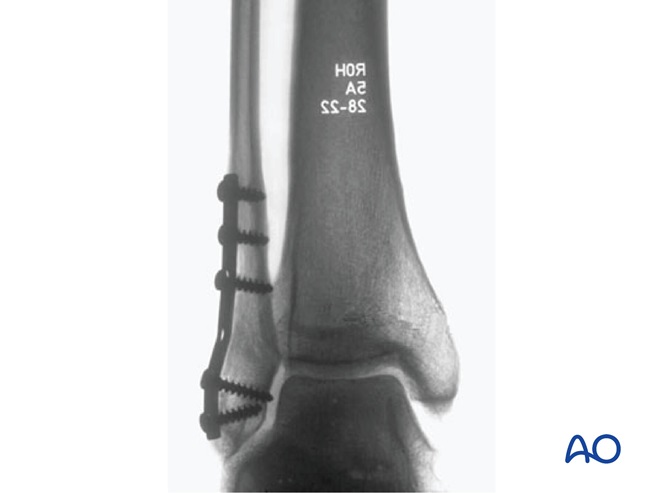 Fibula, transverse fracture: tension band plate