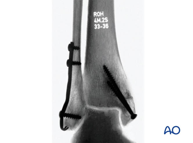 Tension band plate for Infrasyndesmotic, lateral isolated fracture
