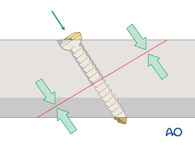 Fibula, oblique B fracture: lag screw and neutralization plate