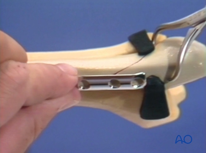 Antiglide plate for Transsyndesmotic, lateral isolated simple fracture