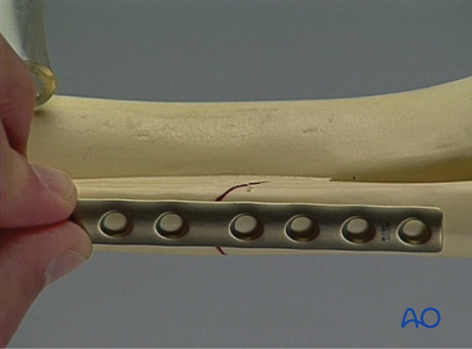 Fibula, transverse or oblique fracture: compression plate