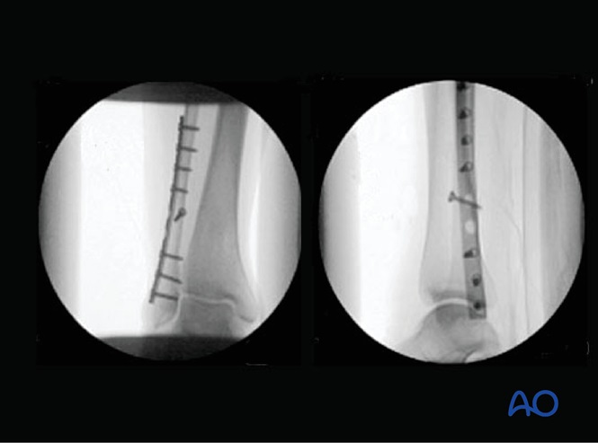 Fibula, oblique C1 fracture: lag screw and neutralization plate