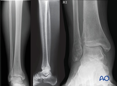 Syndesmosis injury: Fibulo-tibial positioning screw