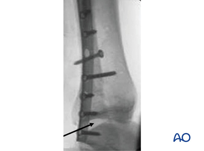 Syndesmosis injury: Fibulo-tibial positioning screw