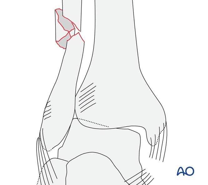 Suprasyndesmotic multifragmentary fibula, medial injury, +/- posterior ...