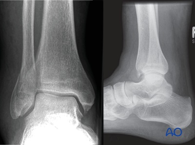 Transsyndesmotic, lateral isolated simple fracture