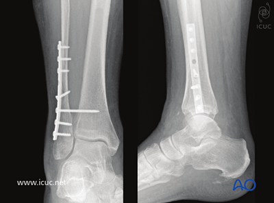 ORIF for Suprasyndesmotic multifragmentary fibula, medial injury ...
