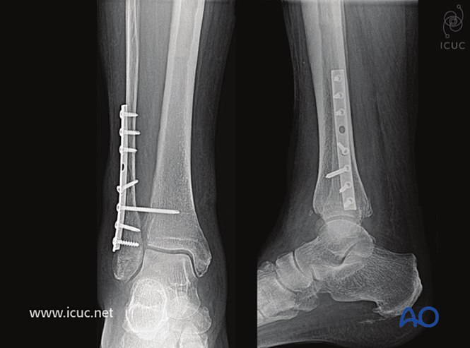 ORIF for Suprasyndesmotic multifragmentary fibula, medial injury ...