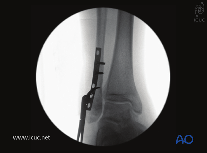 Antiglide plate for Transsyndesmotic, lateral isolated simple fracture