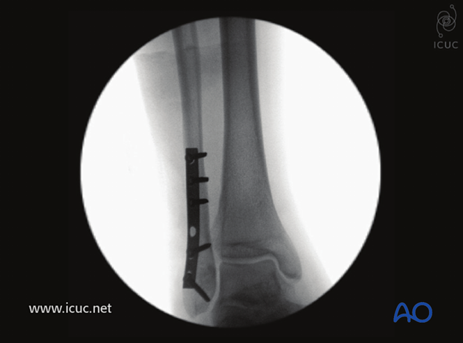Antiglide plate for Transsyndesmotic, lateral isolated simple fracture
