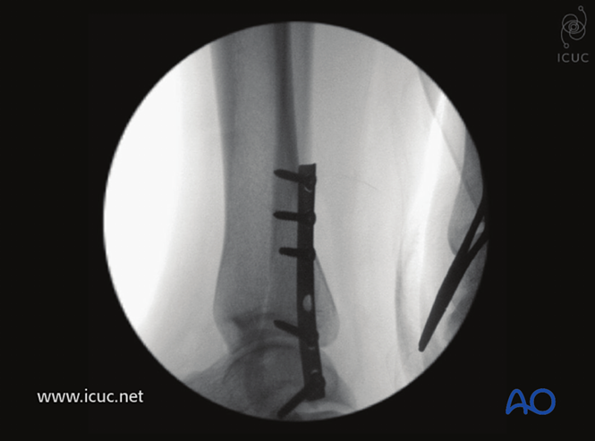 Antiglide plate for Transsyndesmotic, lateral isolated simple fracture