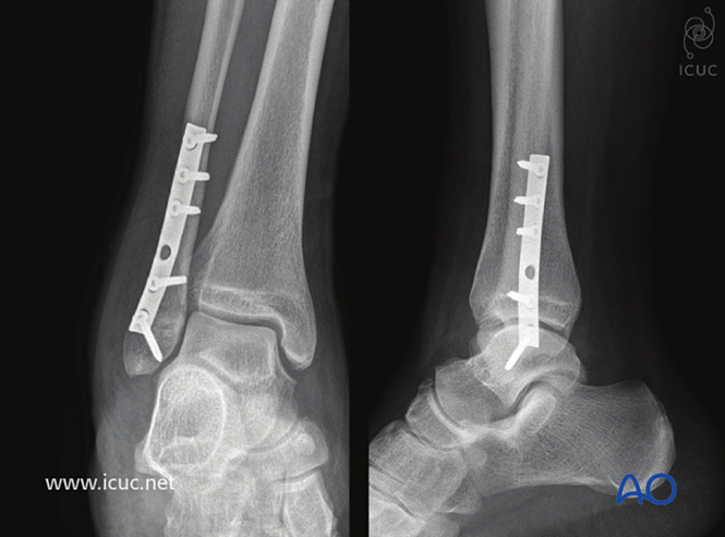 Antiglide plate for Transsyndesmotic, lateral isolated simple fracture
